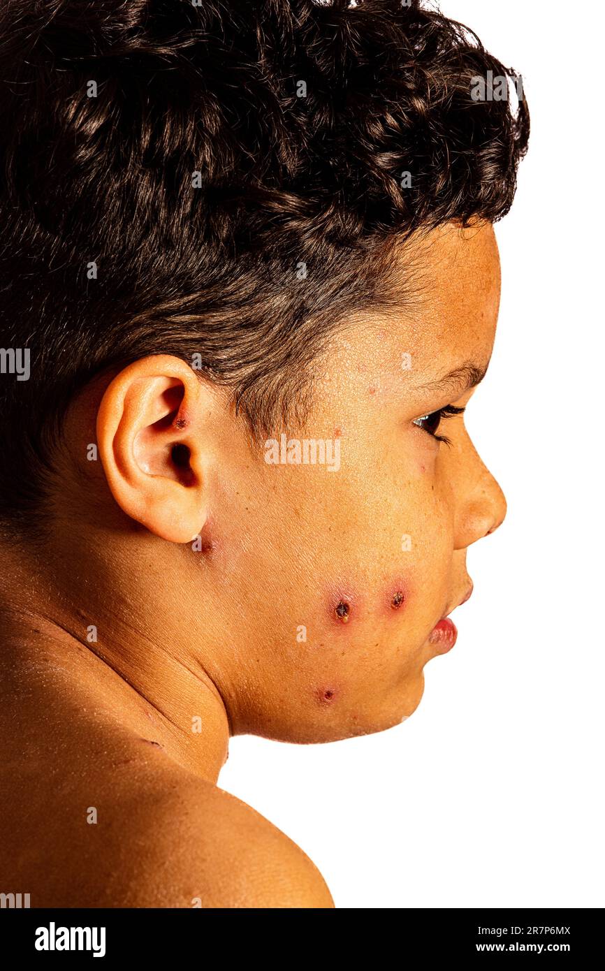Seven year old boy with chickenpox. Chickenpox is a highly contagious ...