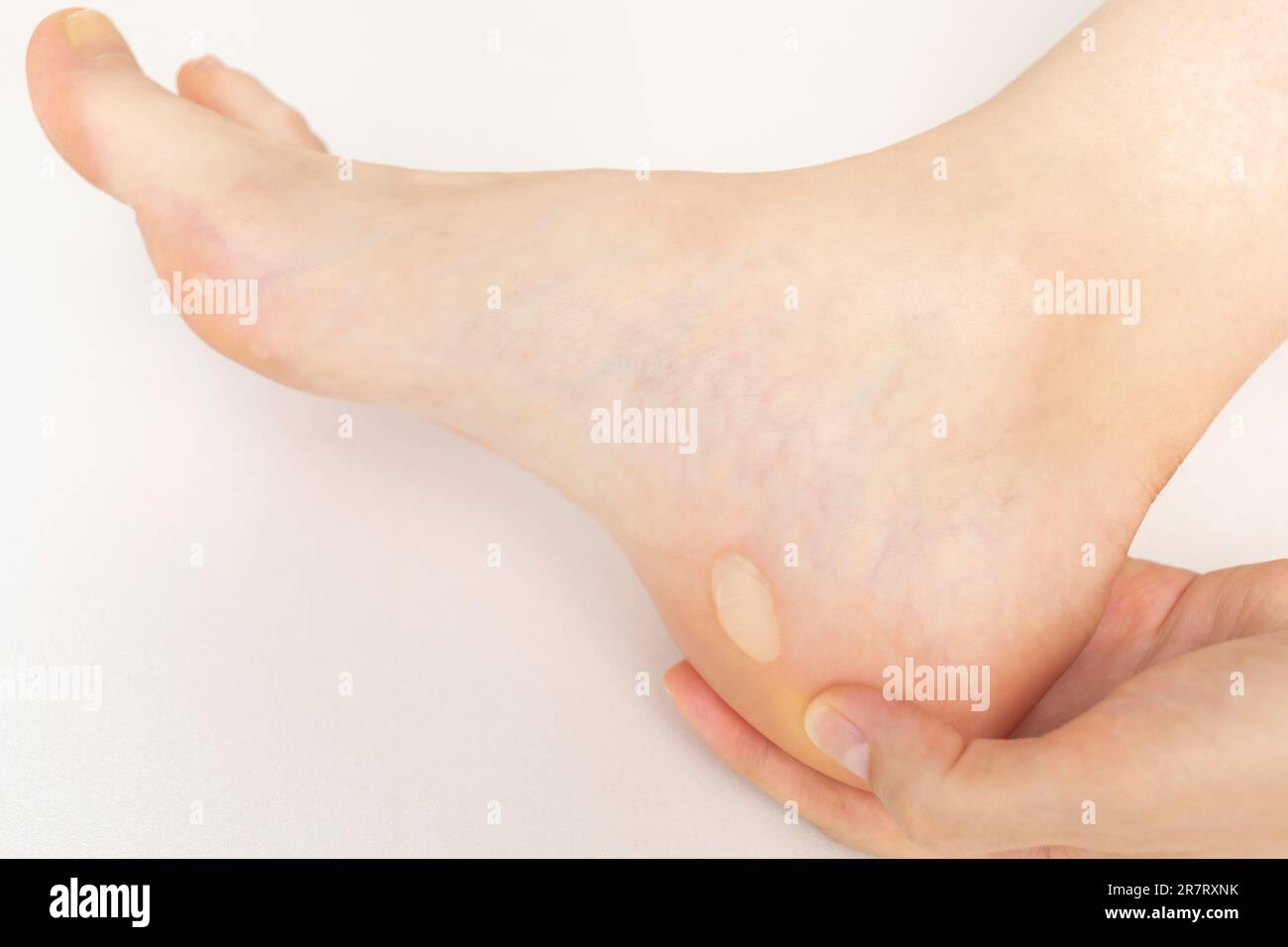 Small Blisters On Bottom Of Foot