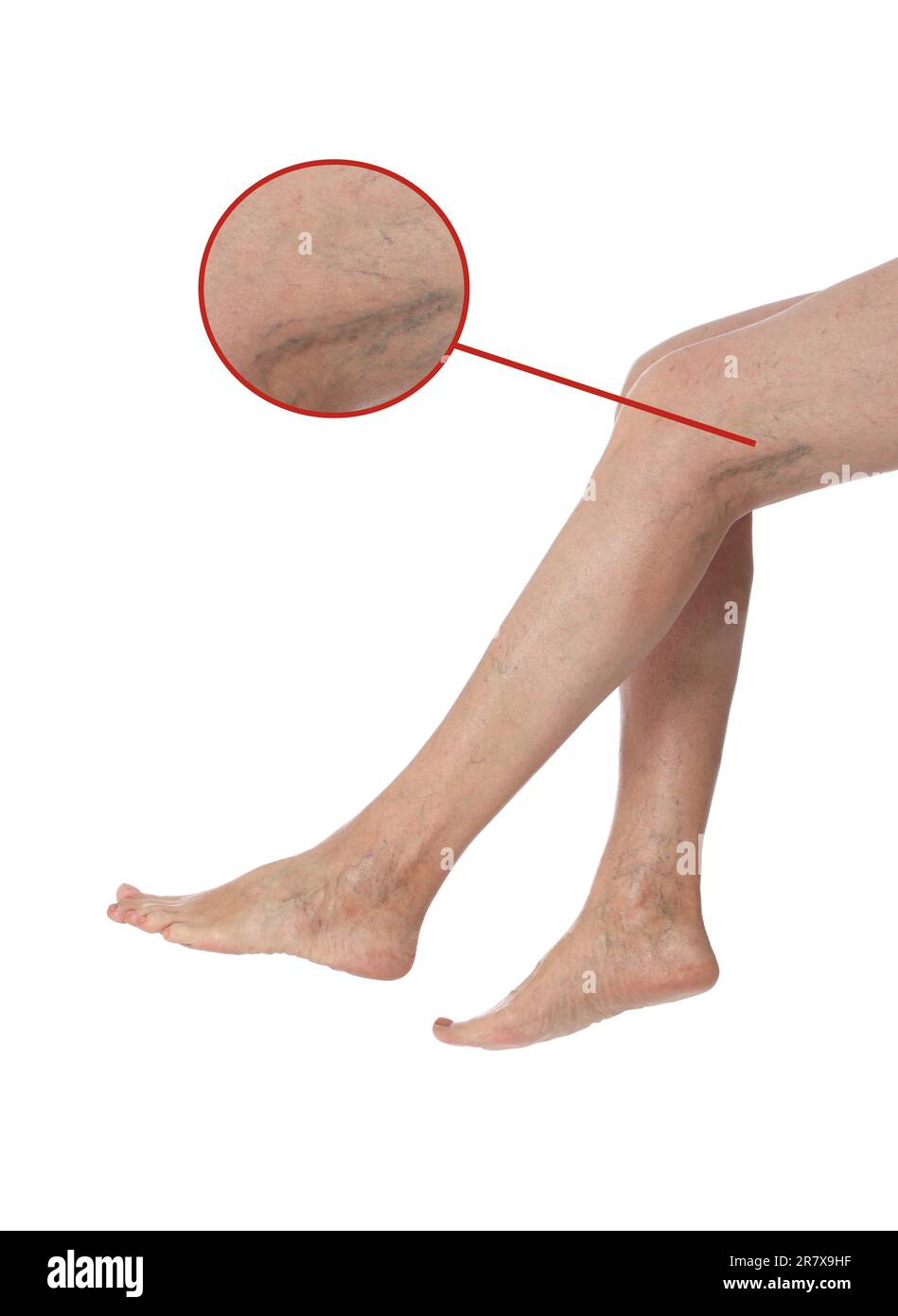 Woman suffering from varicose veins on white background, closeup ...