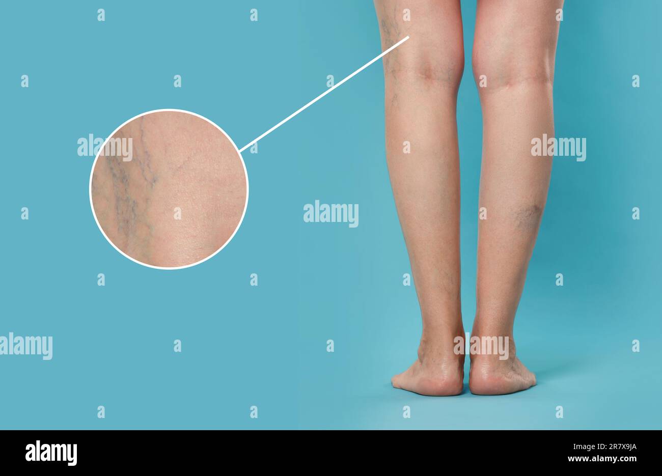 Woman suffering from varicose veins on light blue background, closeup ...