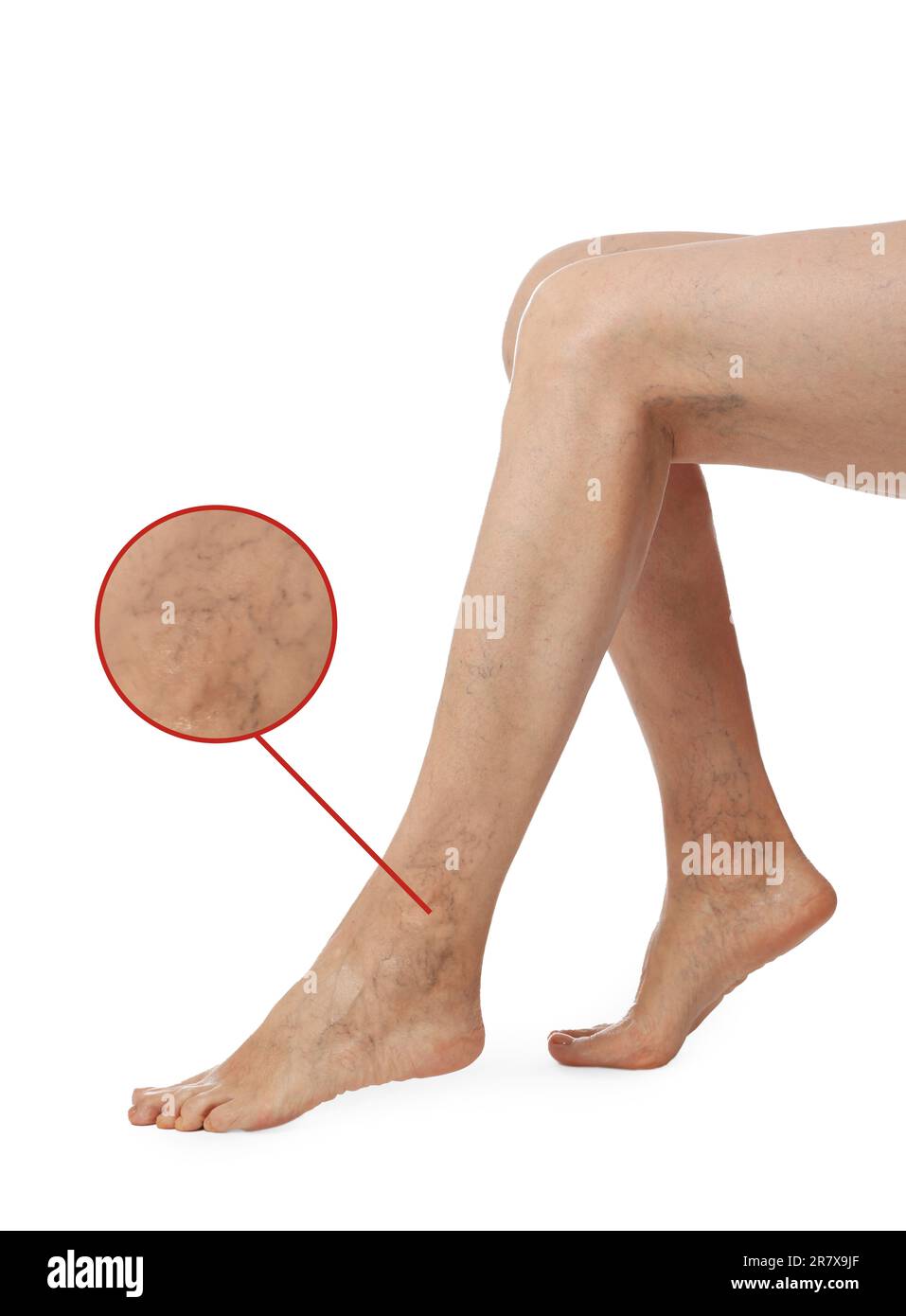 Woman suffering from varicose veins on white background, closeup ...