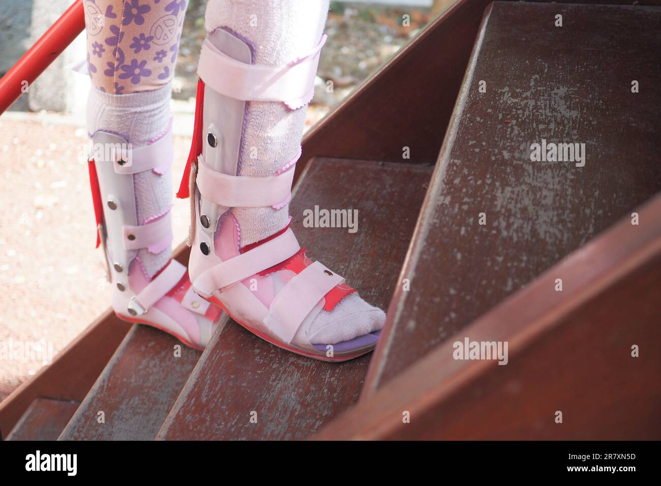 Child cerebral palsy disability, legs orthosis Stock Photo - Alamy