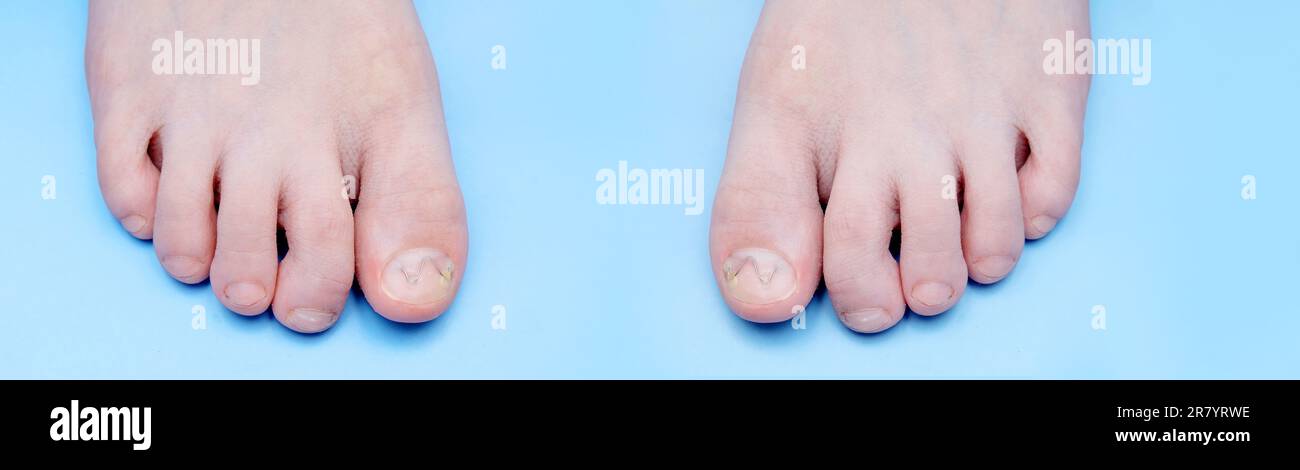 Unibrace banner system on the legs of a teenager in the treatment of an ...