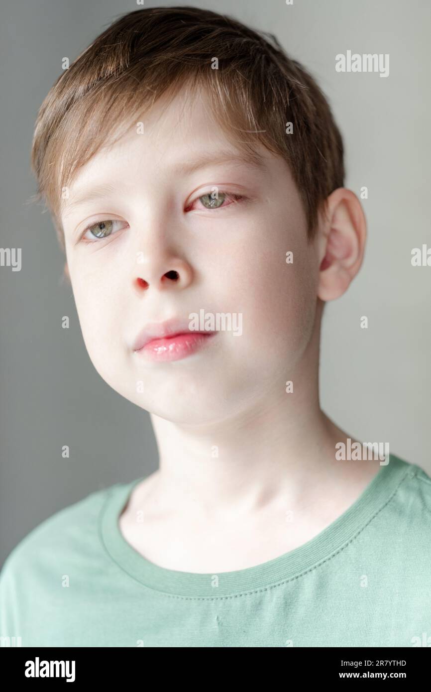 portrait of a boy of European appearance with a red eye from ...