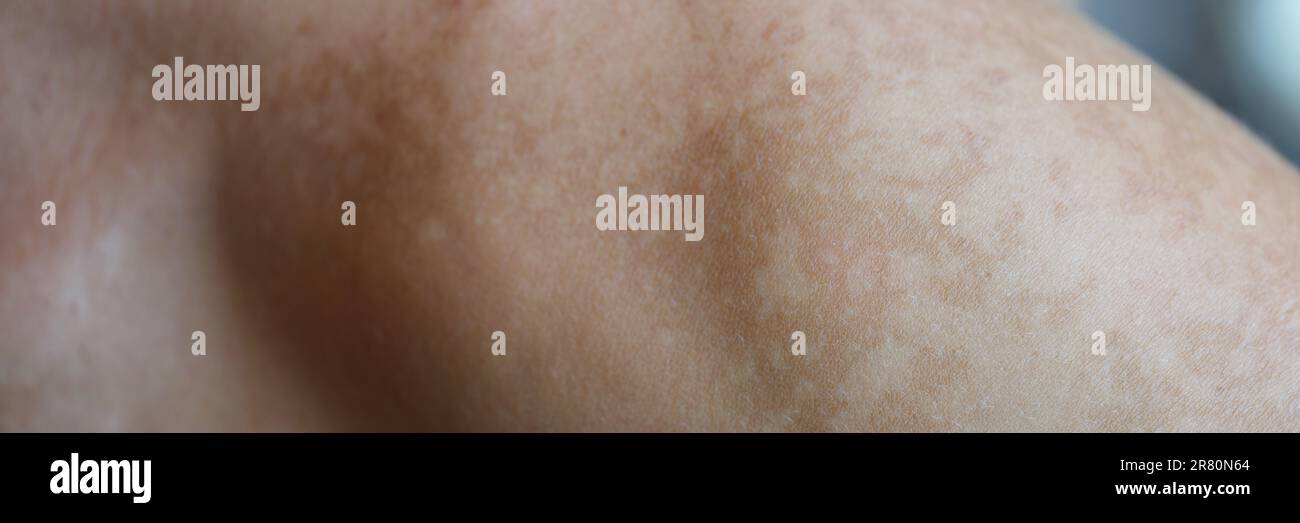 Skin care problem spots on shoulder skin and health concept Stock Photo ...