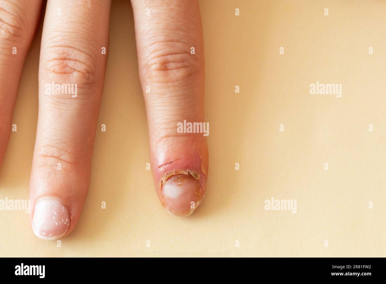 Throbbing finger hi-res stock photography and images - Alamy