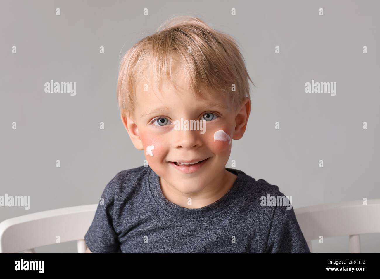Sunburned skin child hi-res stock photography and images - Alamy