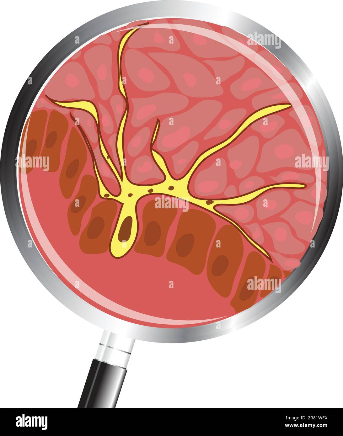 The site of the human skin under a magnifying glass. Albinism. Vector ...