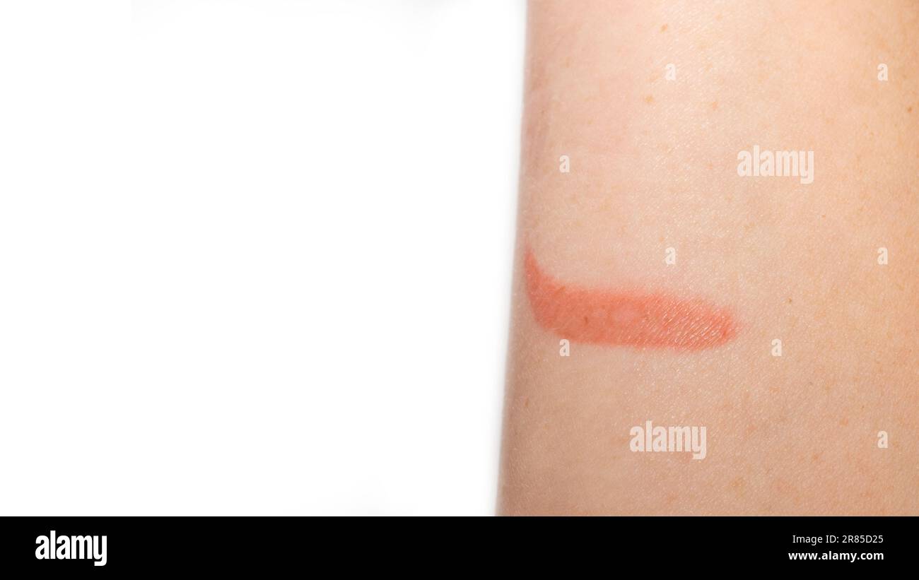 Burn skin not sunburn not sun hi-res stock photography and images - Alamy