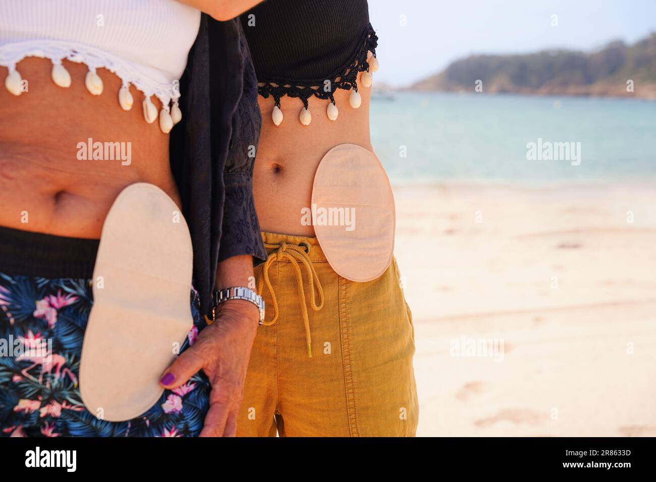 Unrecognizable Two Women With A Ostomy Bag In The Beach Lifestyle With A Colostomy Of A Colon