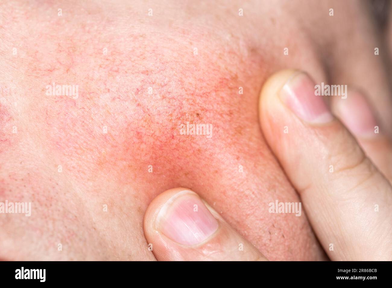 Broken capillaries on the face, Red skin problems, Congested skin. The ...