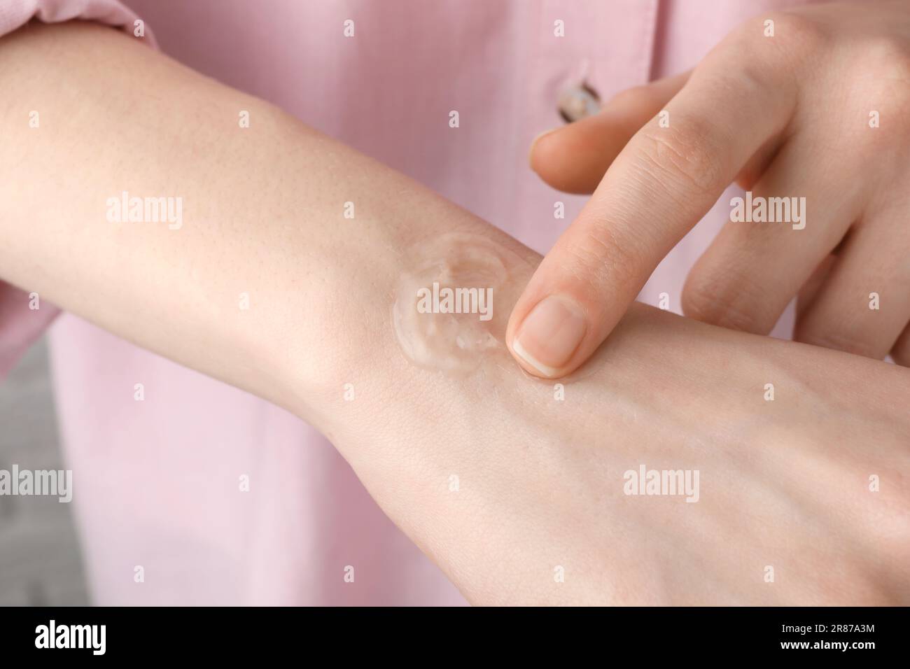 Woman applying ointment on her hand, closeup Stock Photo - Alamy