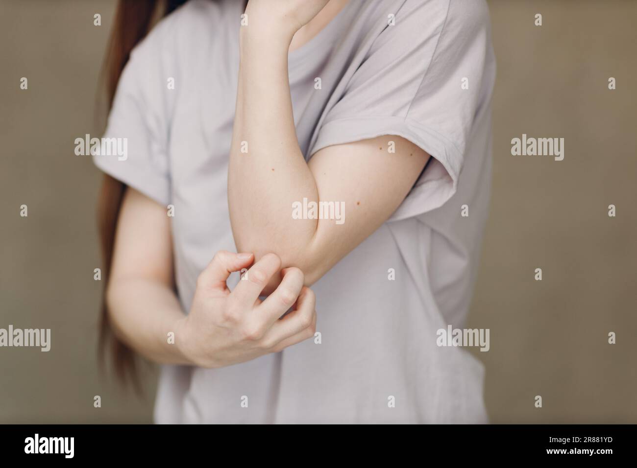 Allergy dermatology scabies itches hand skin problem woman Stock Photo ...