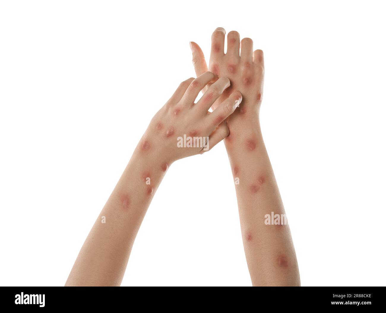 Woman with rash suffering from monkeypox virus on white background ...