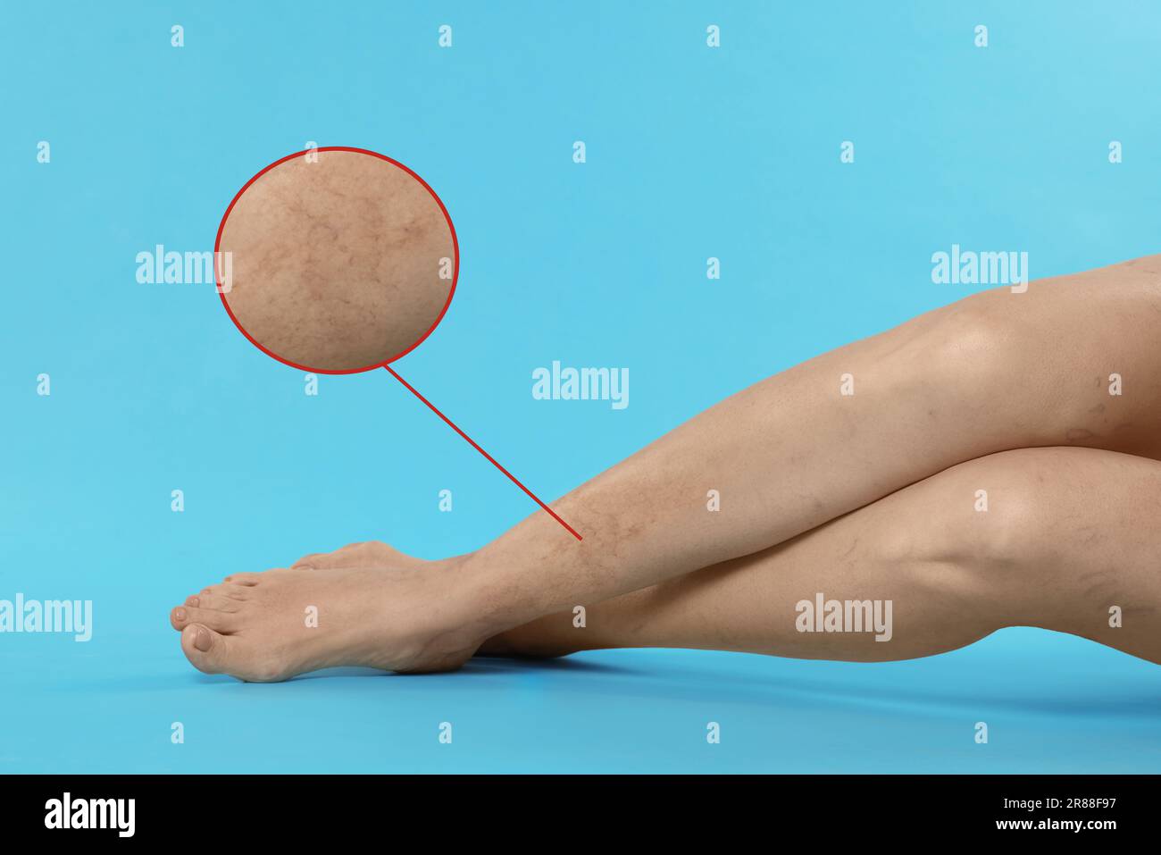 Woman suffering from varicose veins on light blue background, closeup ...