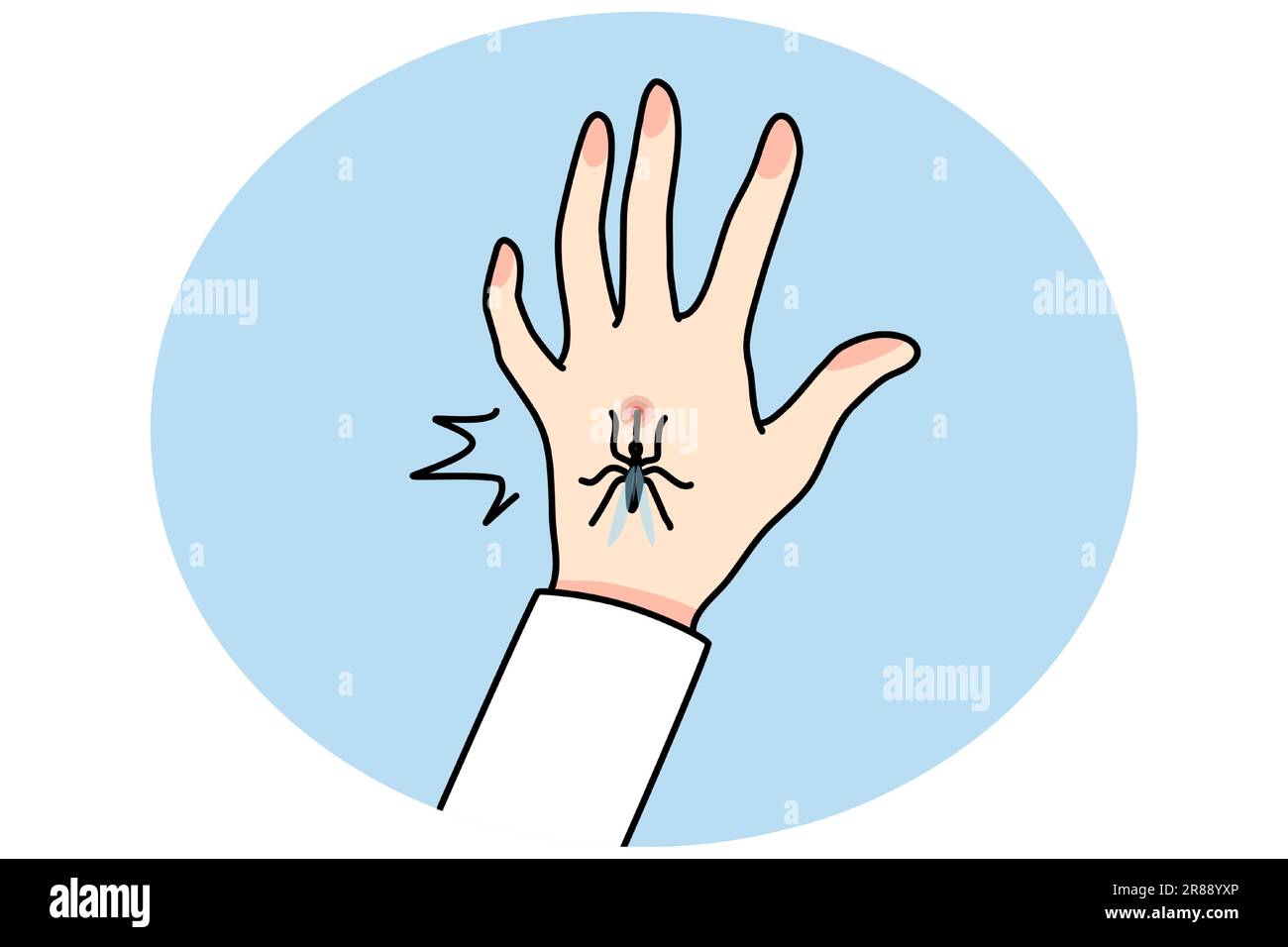 Close up of mosquito bite hand. Bug or insect biting person leave spot ...