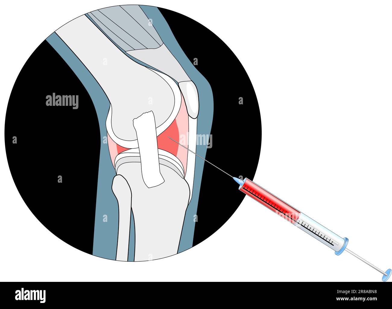 Non-surgical treatments for arthritis. injections into the painful joint. Efficacy of Platelet ...