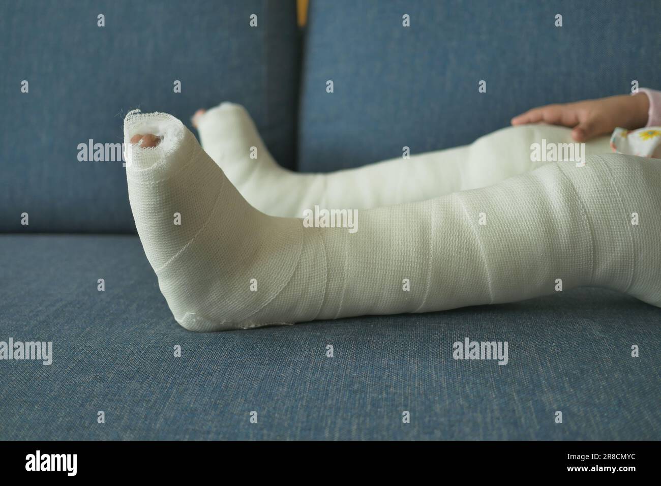 little child with plaster bandage on leg Stock Photo - Alamy