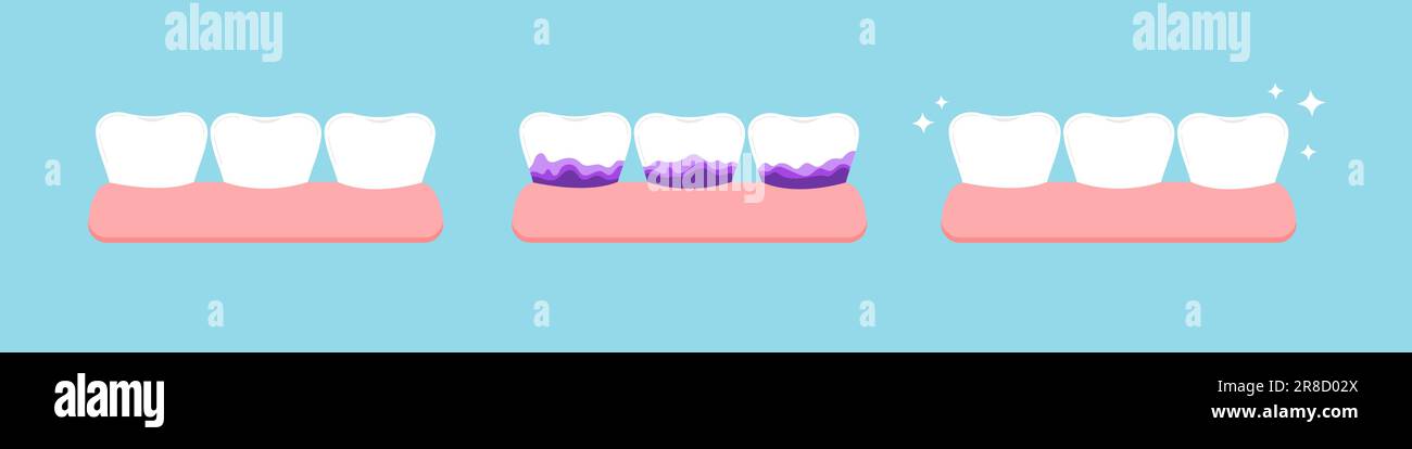 White tooth and with yellow tartar plaque before after plaque test icon ...