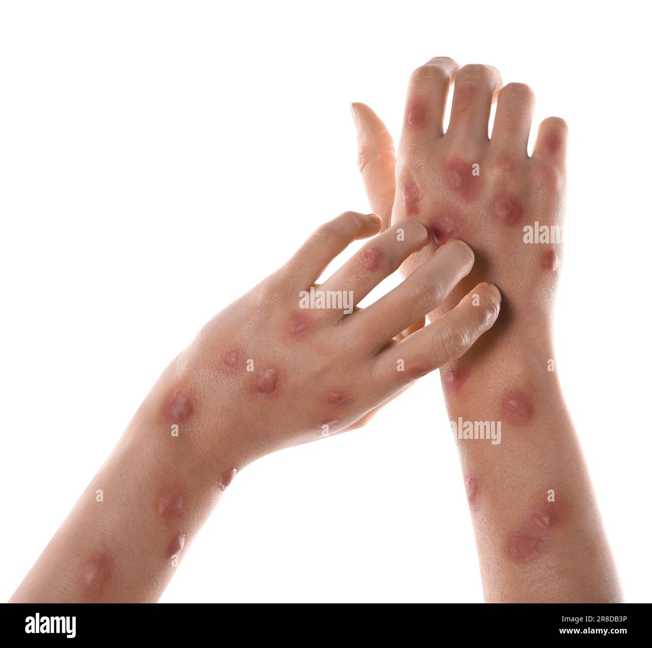 Woman with rash suffering from monkeypox virus on white background ...