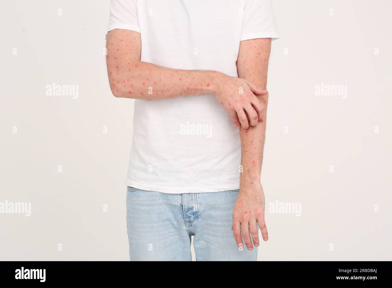 Rash on hands hi-res stock photography and images - Alamy