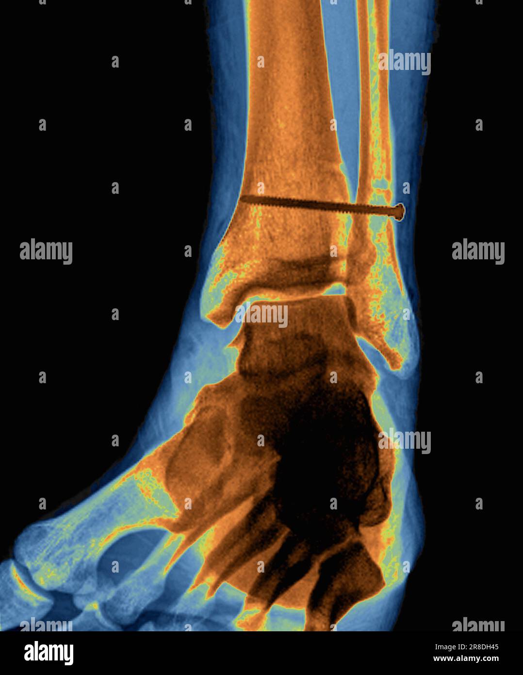Coloured X-ray of the pinned ankle of a 32 year old male patient. A ...