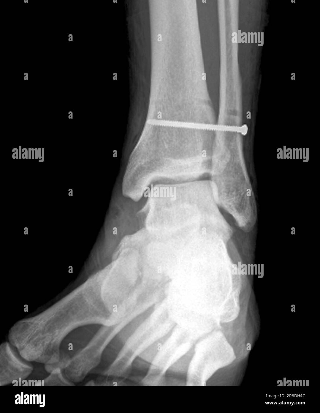 X-ray of the pinned ankle of a 32 year old male patient. A screw is ...