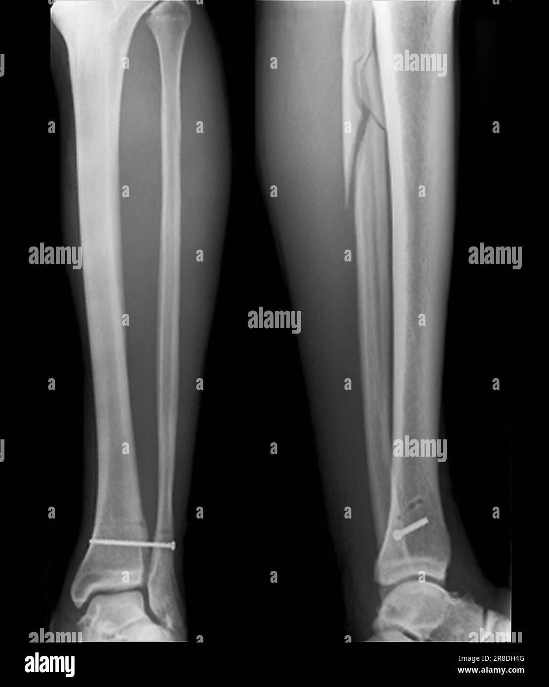X-rays of the pinned ankle of a 32 year old male patient. A screw is ...