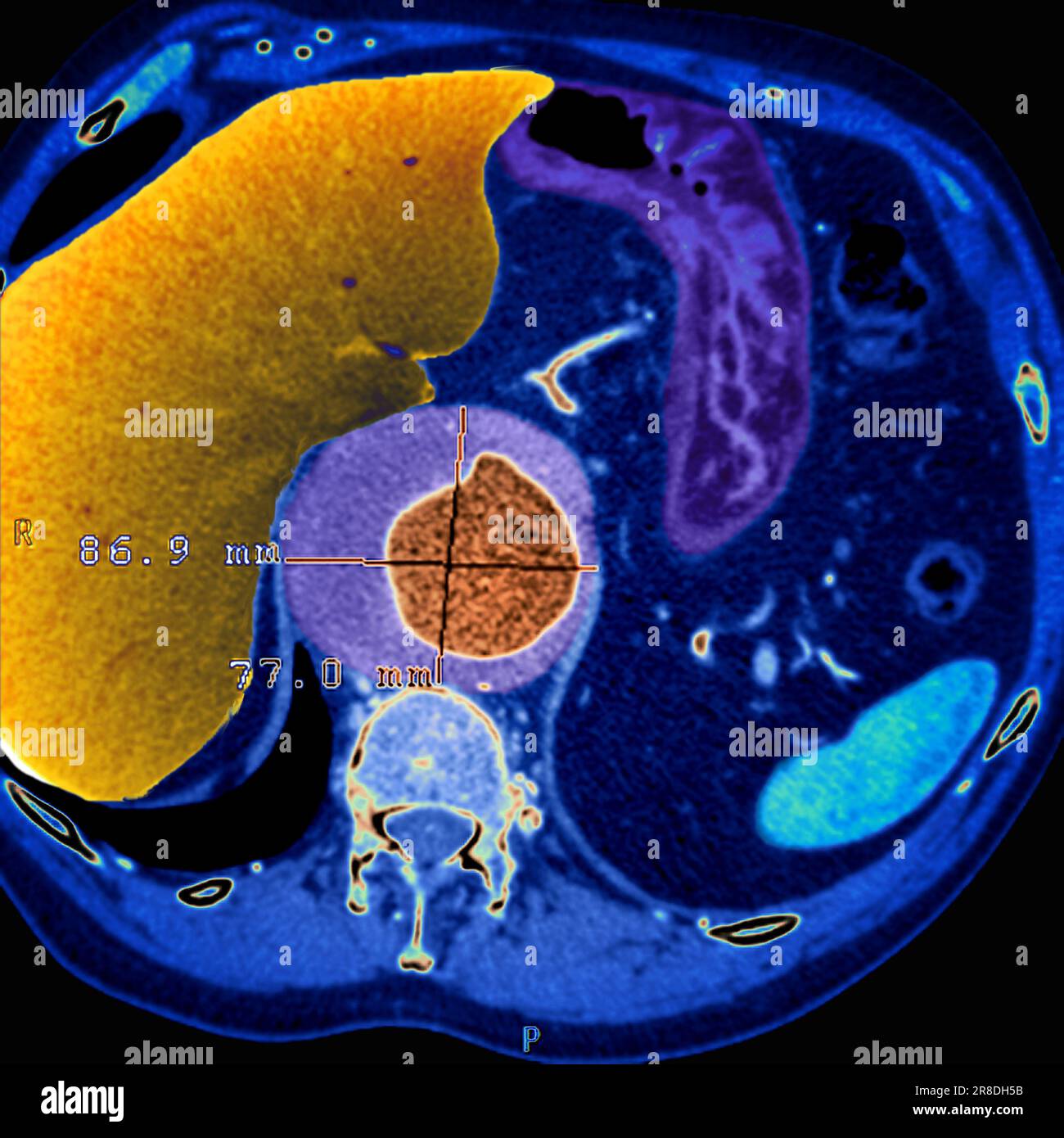 Abdominal aortic aneurysm, CT scan Stock Photo - Alamy