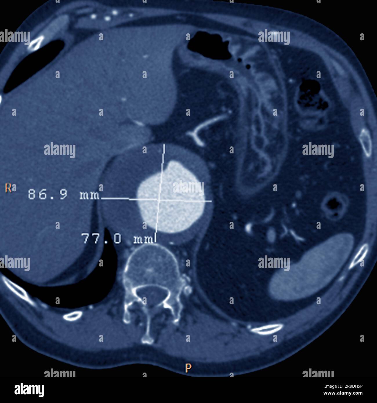 Abdominal aortic aneurysm, CT scan Stock Photo - Alamy