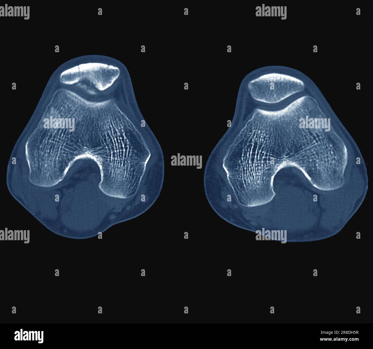 Coloured 3D computer tomography (CT) scan of the knees of an 18 year ...