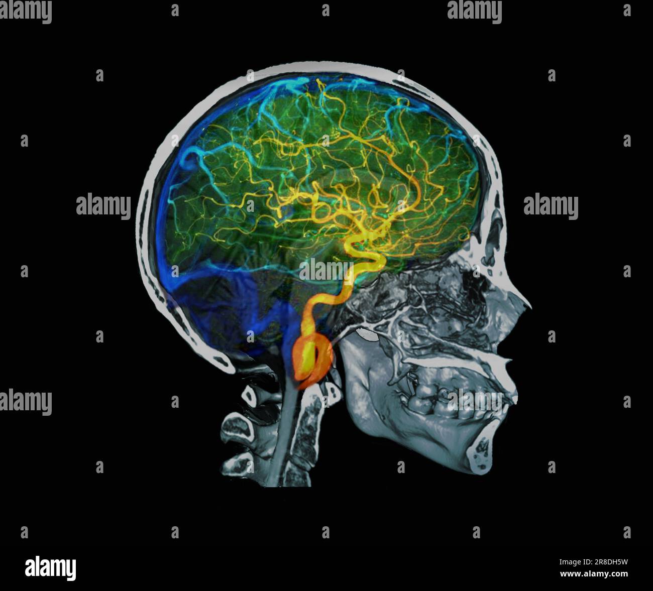Coloured 3D computed tomography (CT) angiogram scan showing the arteries and veins supplying and ...
