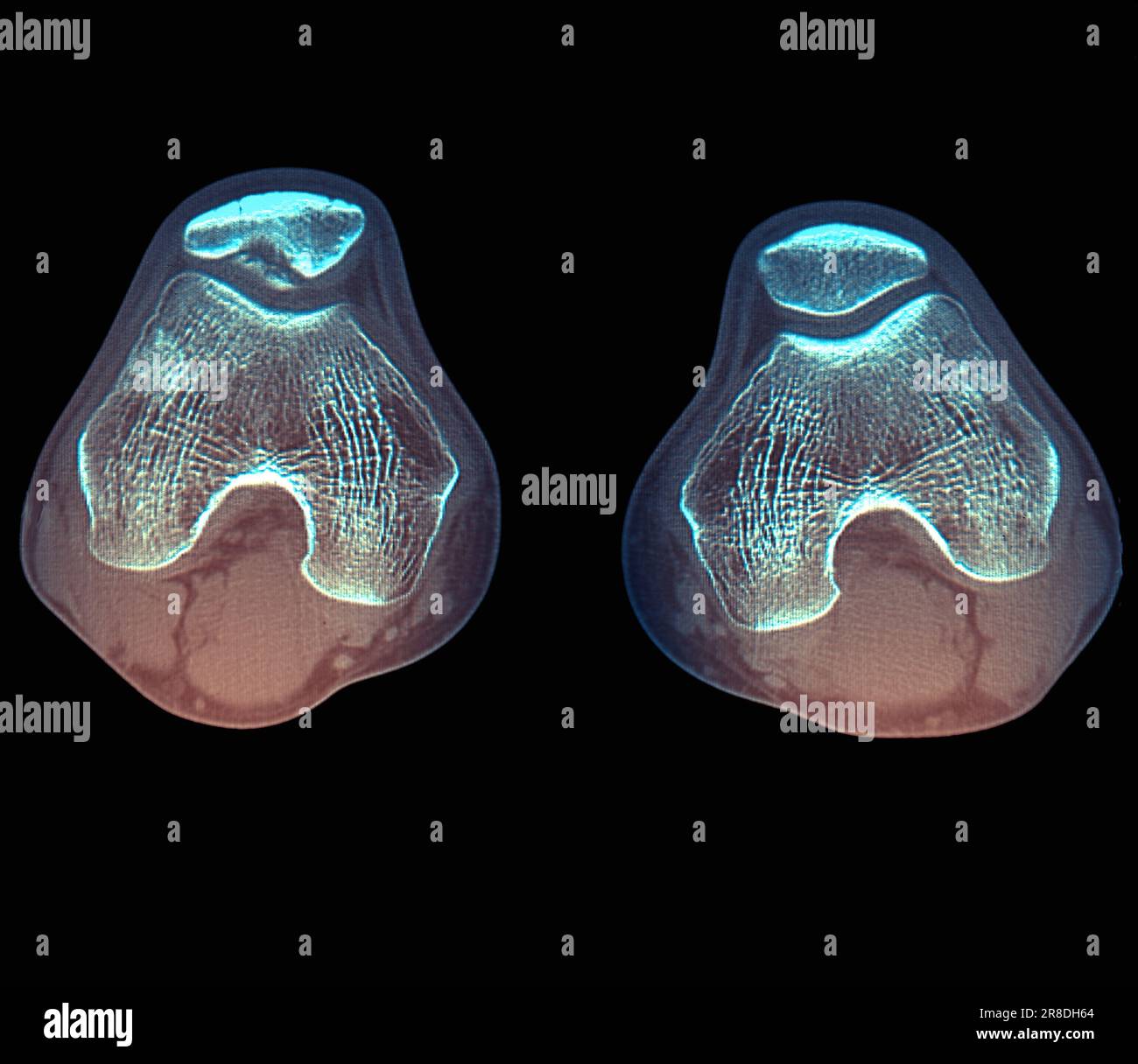 Coloured 3D computer tomography (CT) scan of the knees of an 18 year ...