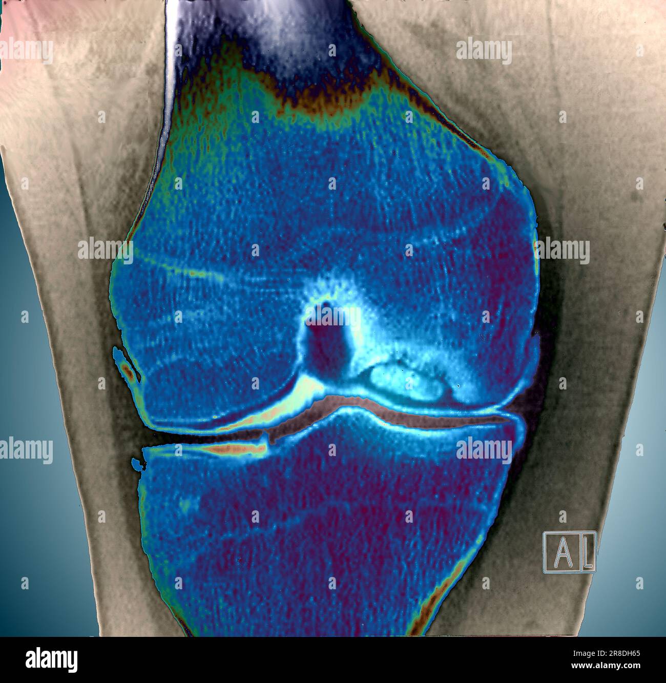 Coloured 3D computer tomography (CT) scan of the right knee of an 18 ...
