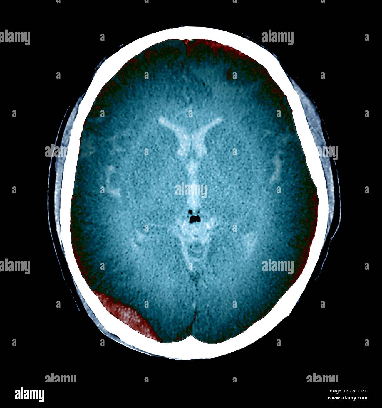 Coloured computed tomography (CT) scan of the brain of a 32 year old male patient after a road ...
