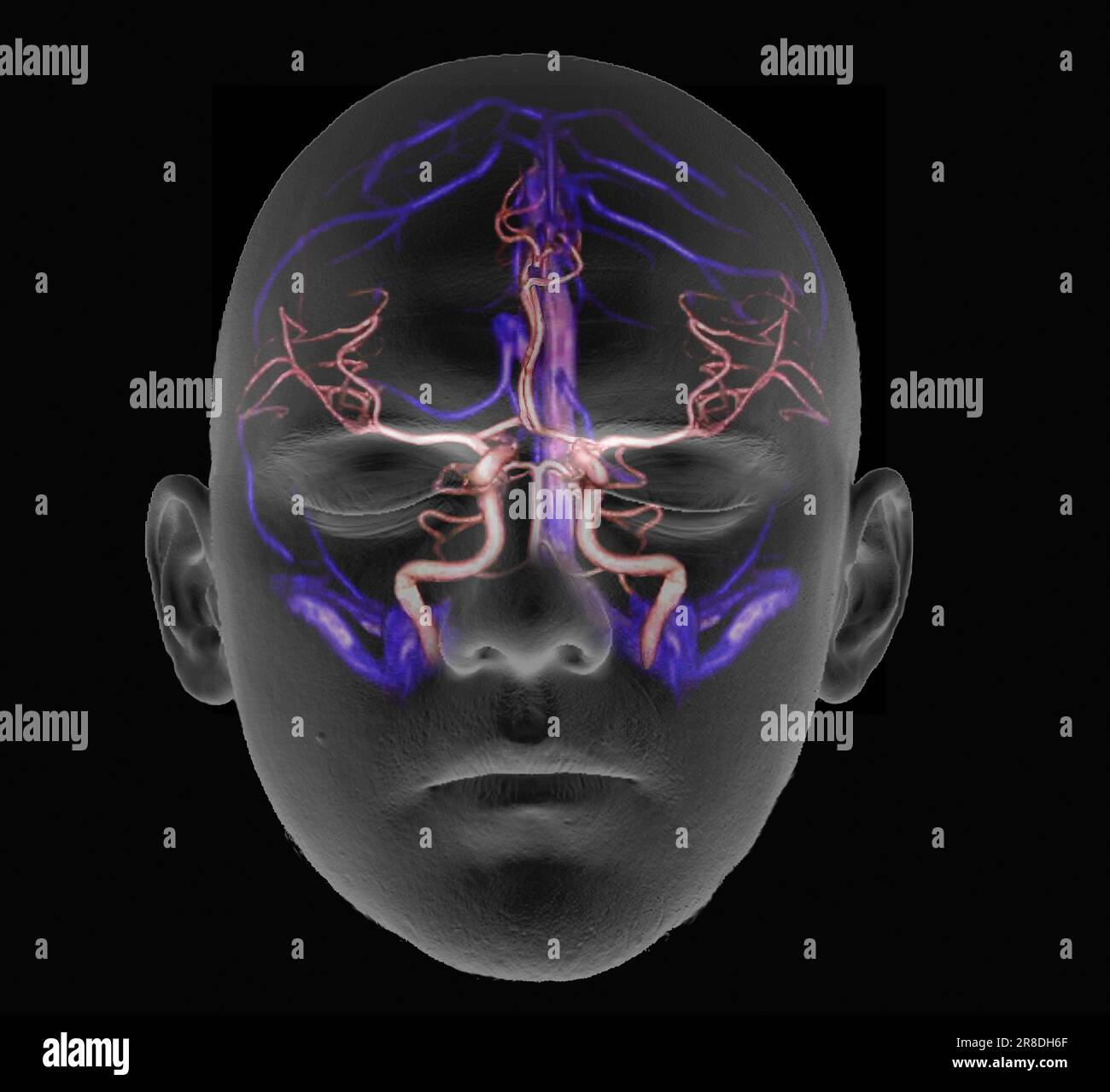 Coloured 3D computed tomography (CT) angiogram scan showing the arteries and veins supplying and ...