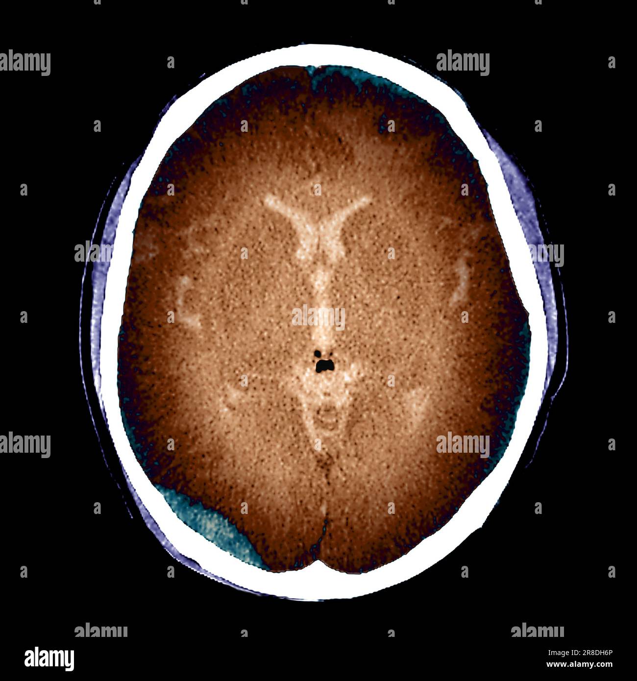 Coloured computed tomography (CT) scan of the brain of a 32 year old ...