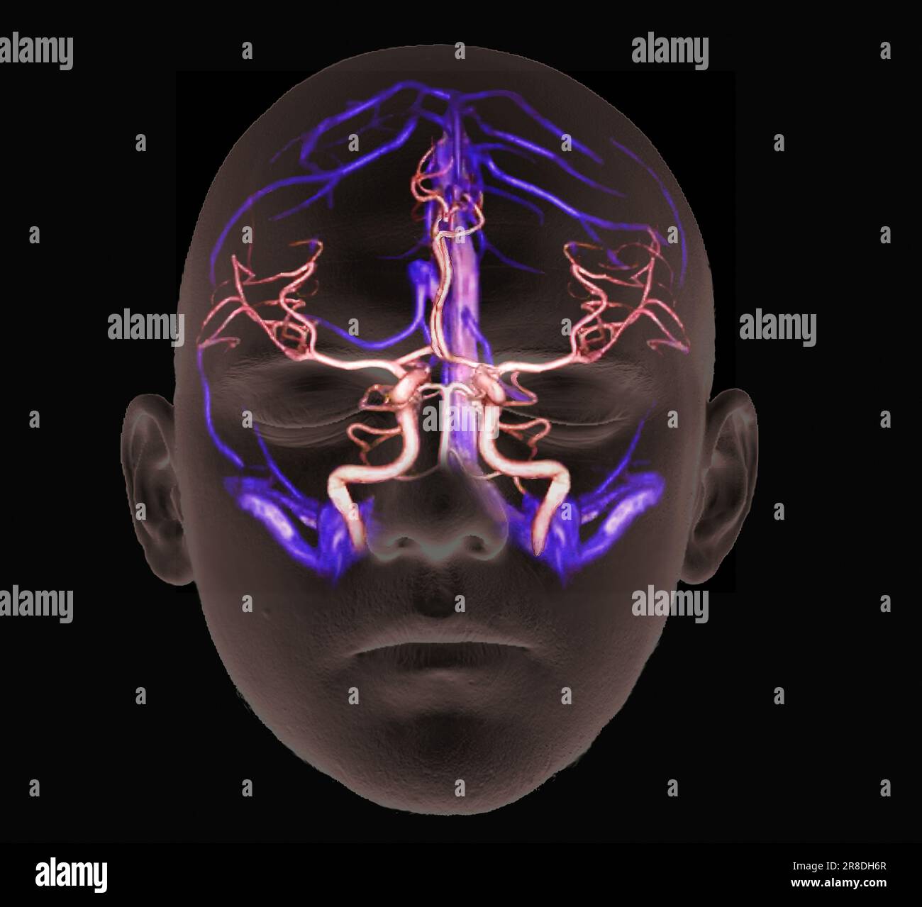 Coloured 3D computed tomography (CT) angiogram scan showing the arteries and veins supplying and ...