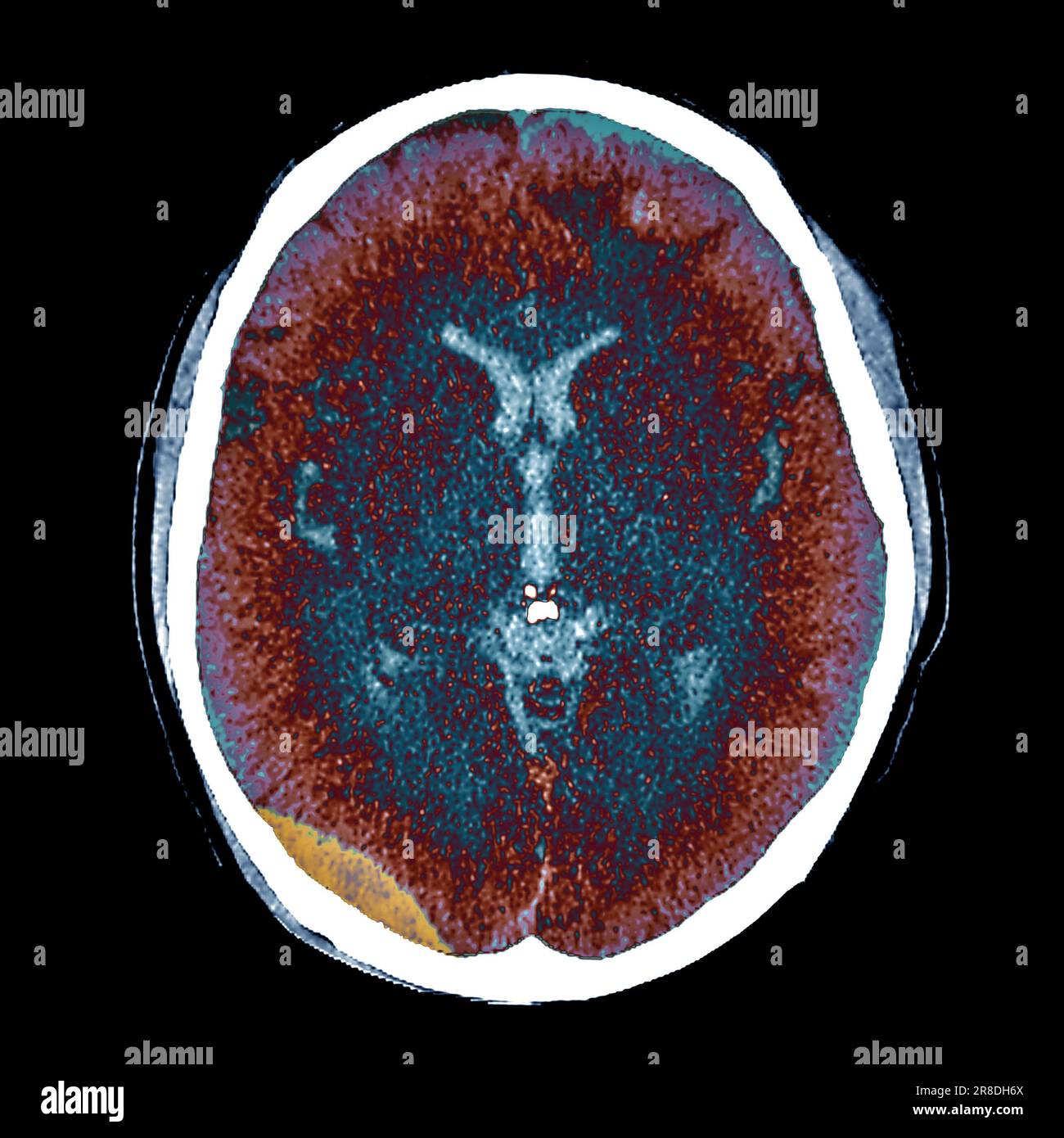 Coloured computed tomography (CT) scan of the brain of a 32 year old male patient after a road ...