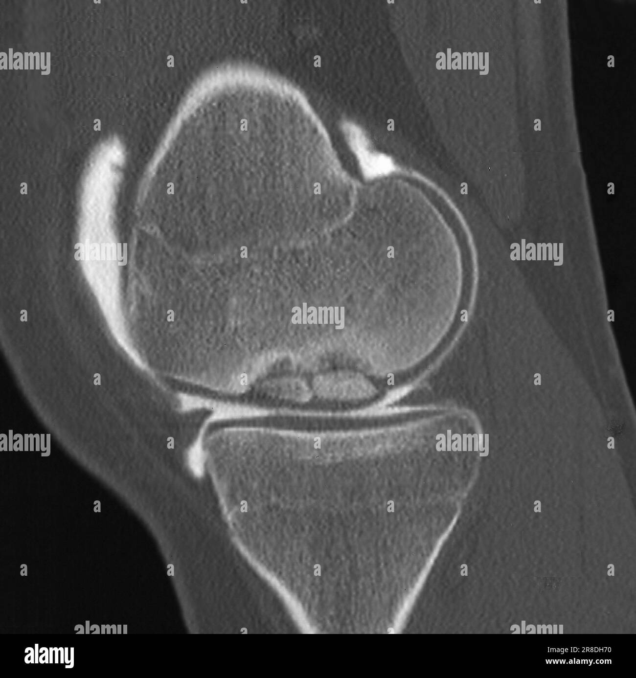 3D computer tomography (CT) scan of the right knee of an 18 year old ...
