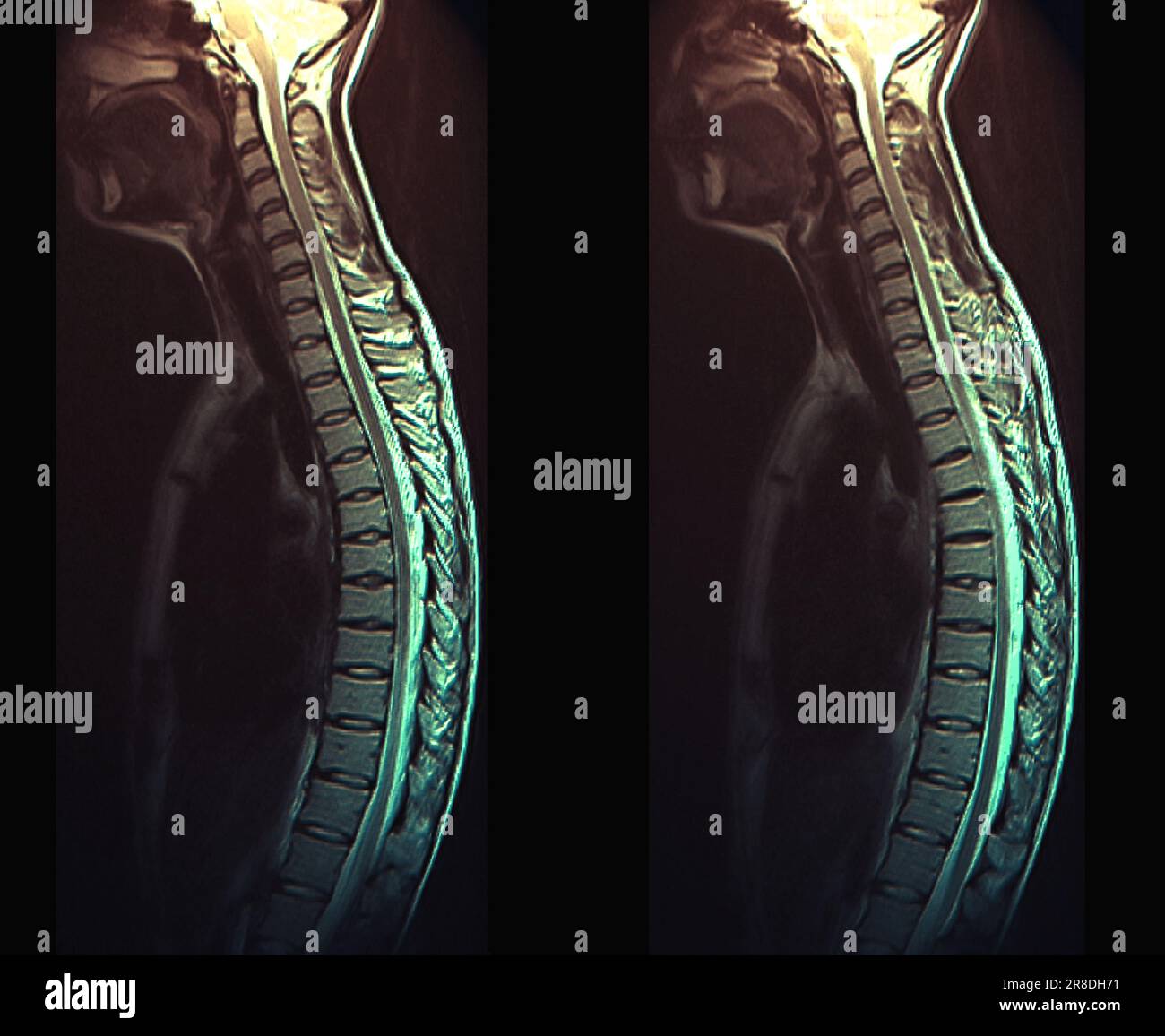 Coloured magnetic resonance imaging (MRI) scans of the healthy spine of ...