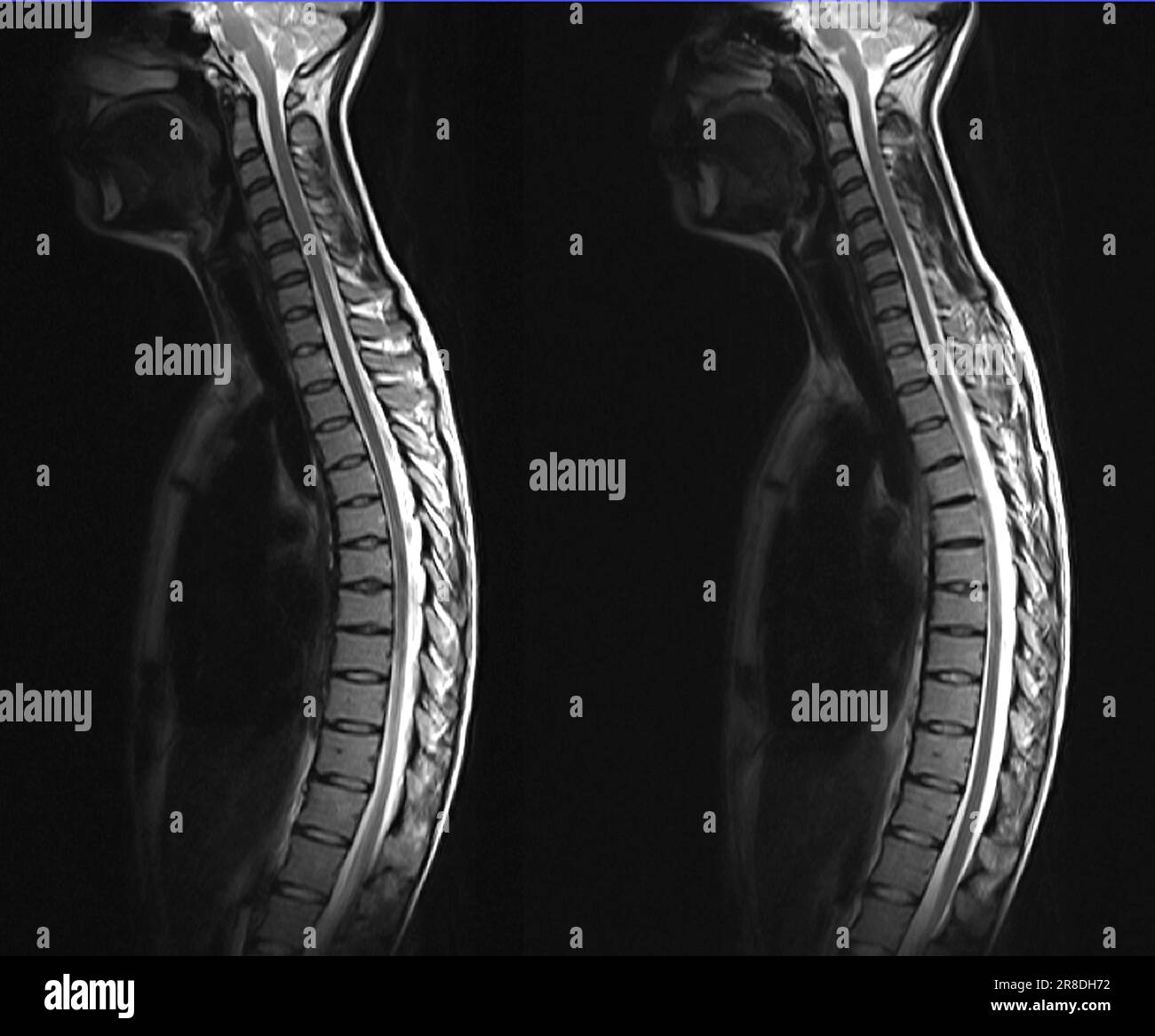 Magnetic resonance imaging (MRI) scans of the healthy spine of a 32 ...