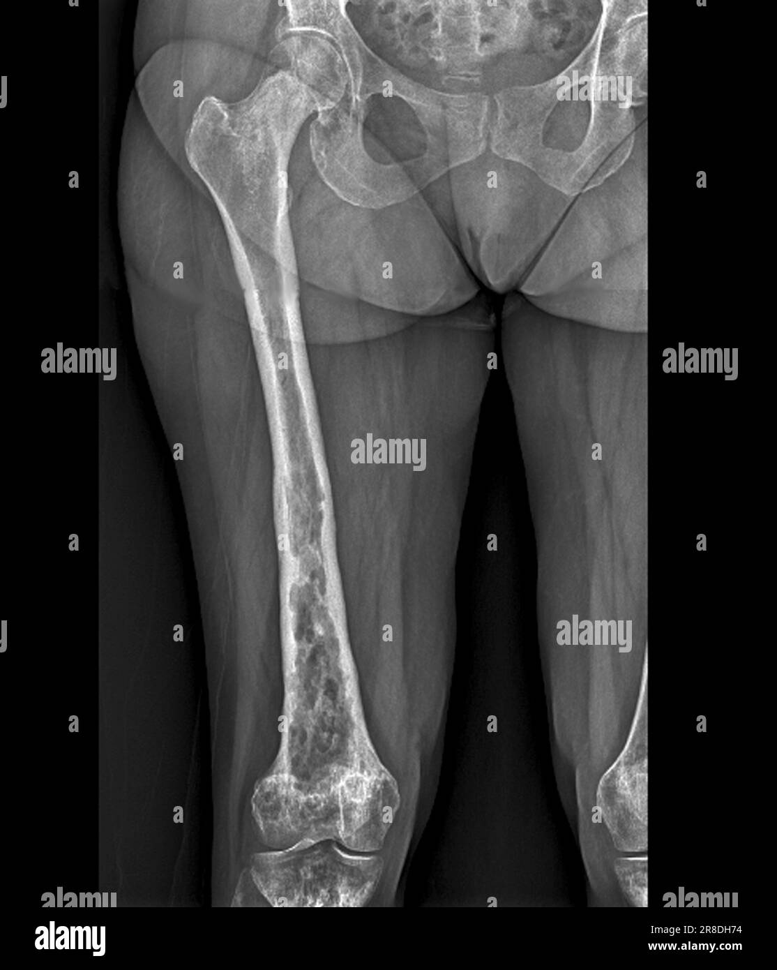 X-ray of lesions in the femur (thigh bone) of a 60 year old female ...