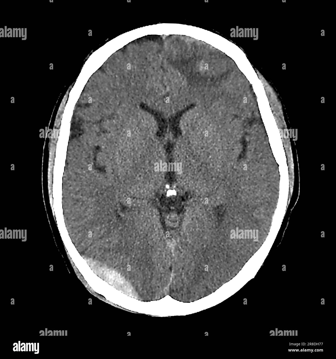 Computed tomography (CT) scan of the brain of a 32 year old male ...