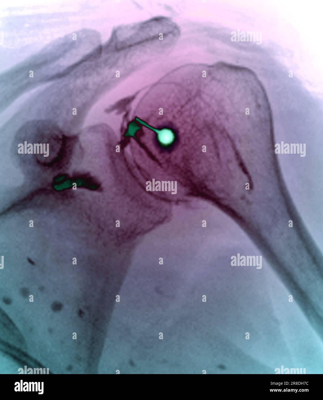 Coloured X-ray of a corticosteroid drug being injected into the ...