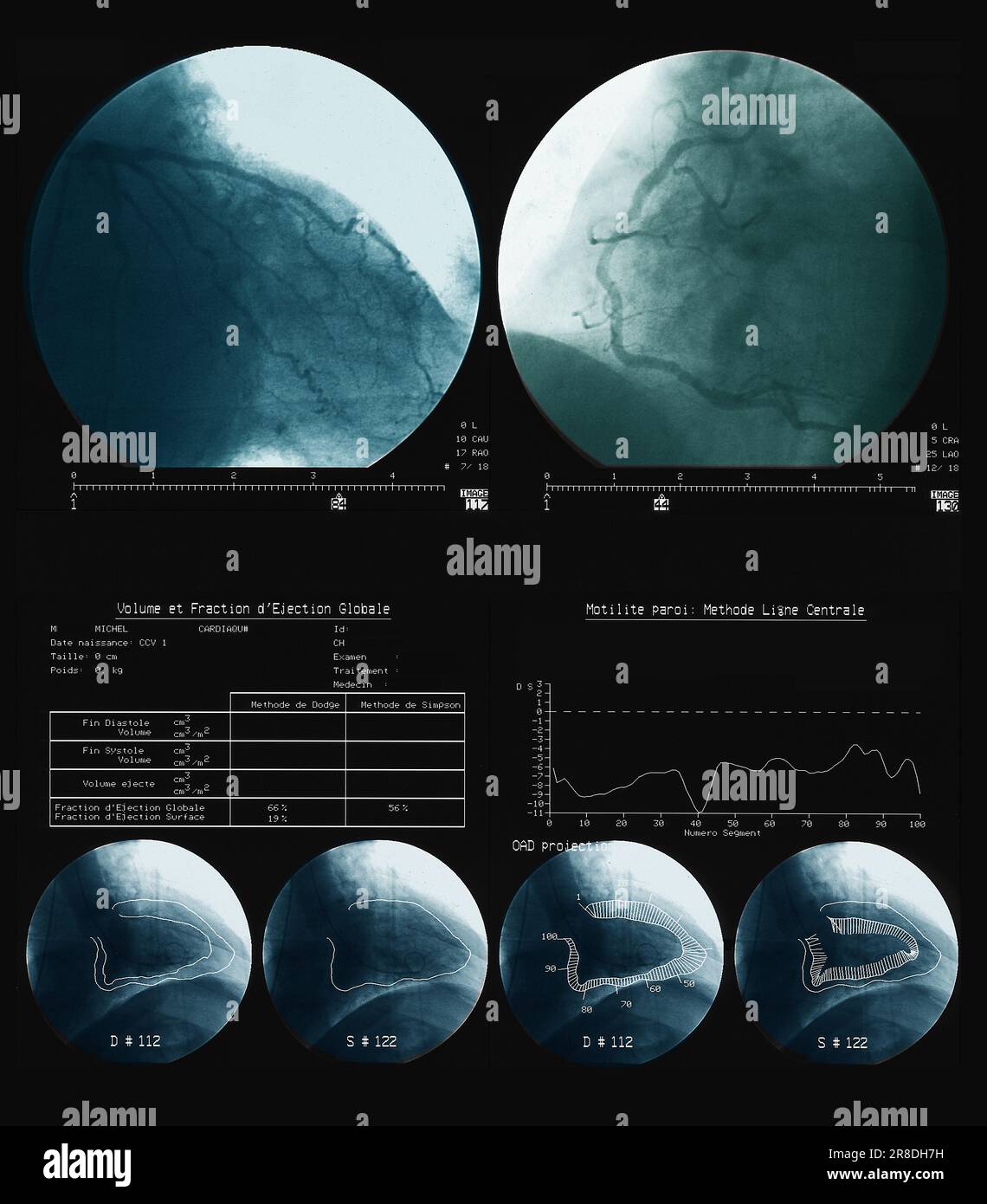 Cardiac output examinations. Coloured coronary angiograms (blood vessel ...