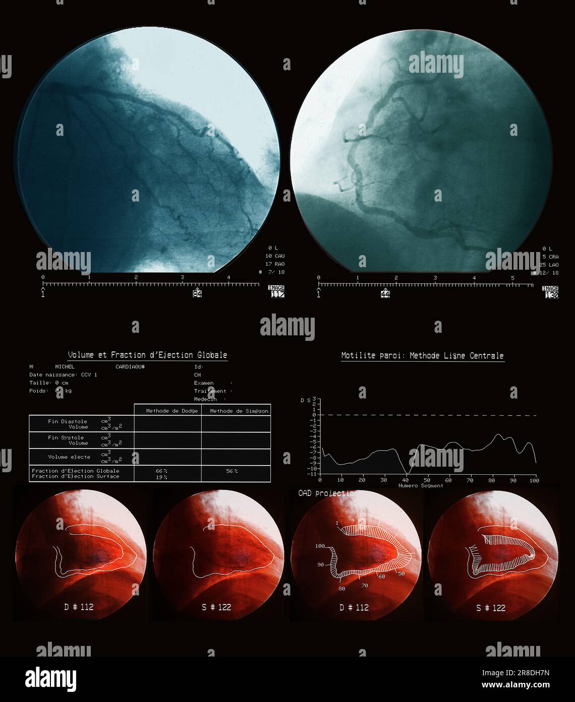 Cardiac output examinations. Coloured coronary angiograms (blood vessel ...