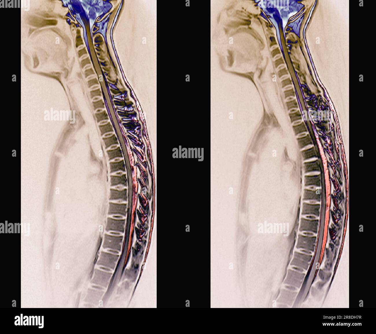 Coloured magnetic resonance imaging (MRI) scans of the healthy spine of ...