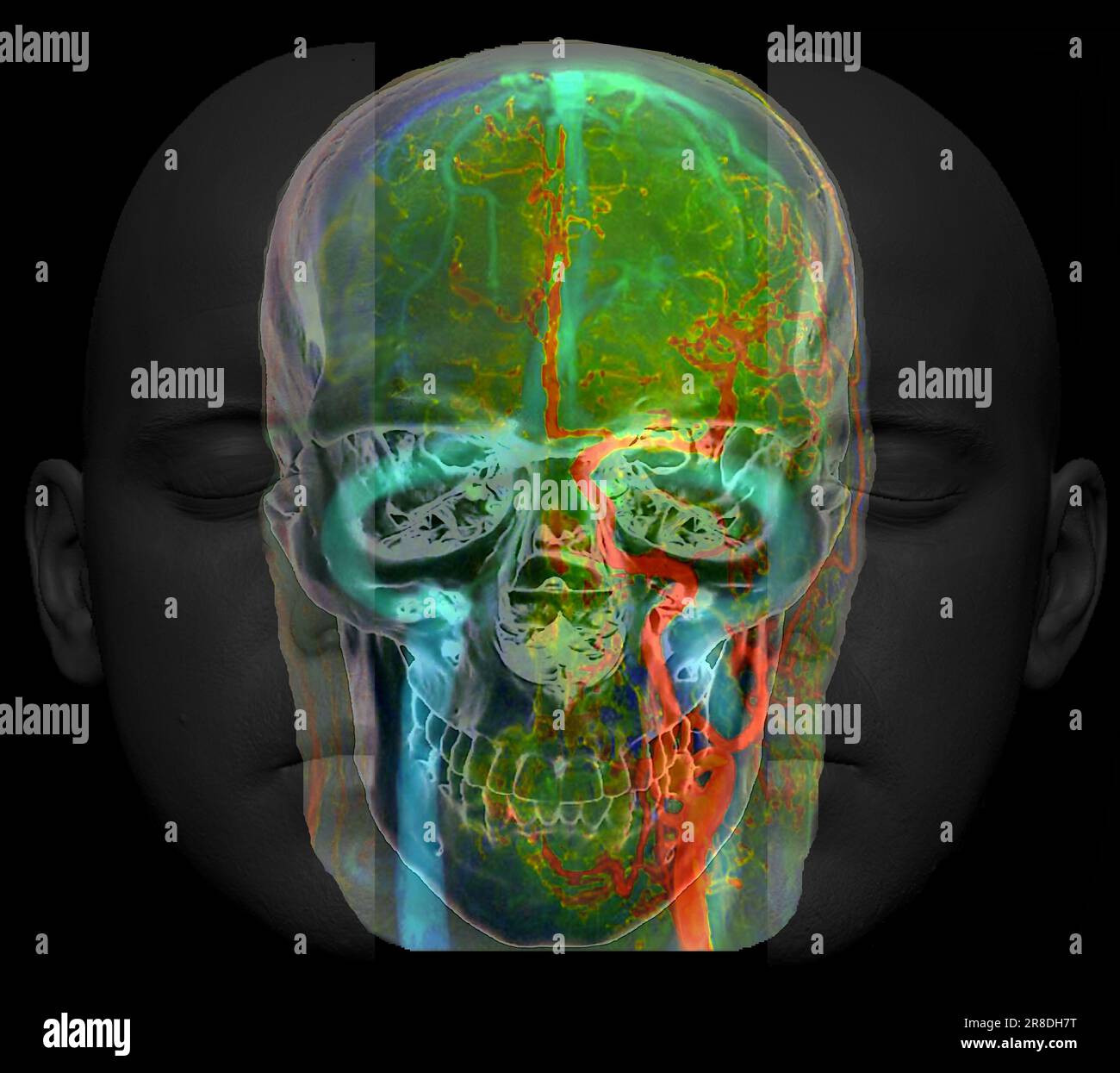 Coloured 3D computed tomography (CT) angiogram scan showing the arteries (red) and veins (blue ...