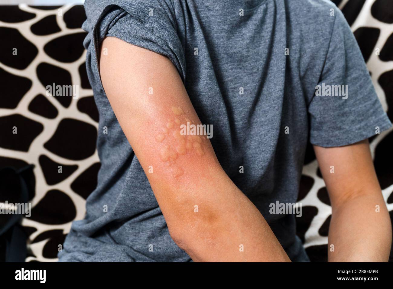 Male itching, allergic reaction. Sensitive Skin, Food Allergy symptoms ...